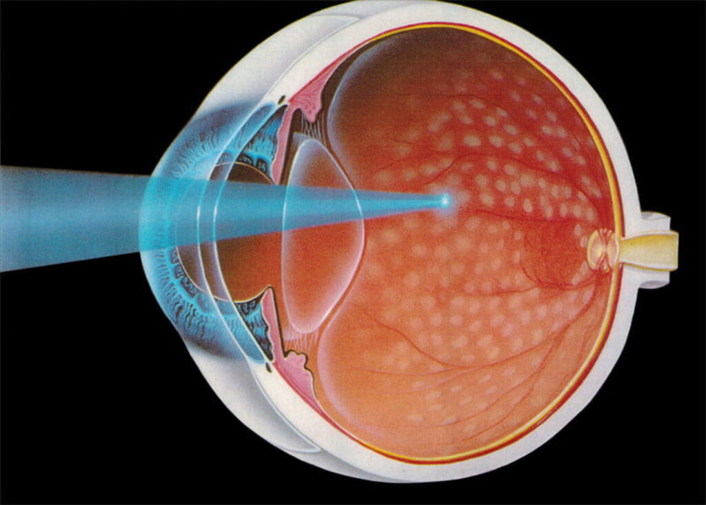 Retinal Detachment Surgery – Sudeep Advance Retina Care